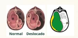 Deslocamento de abomaso: como garantir a saúde do rebanho?